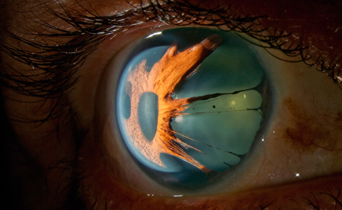 C_09_Chappell_ICESyndrome_1080 | AIMBI